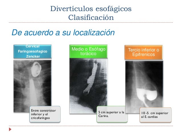 Diverticulo Epifrenico