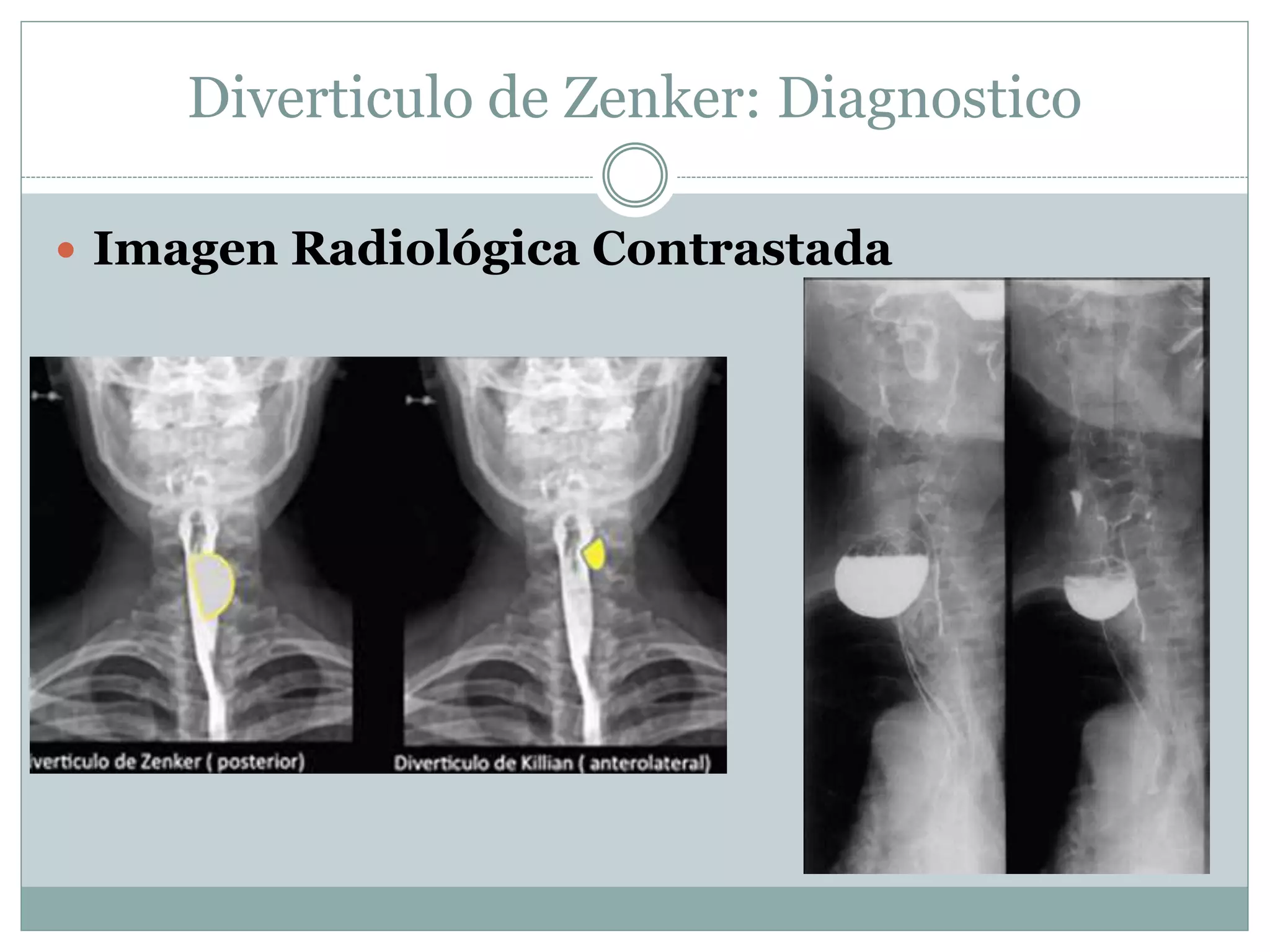 Diverticulos esofagicos | PPTX