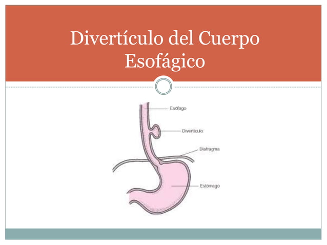 Diverticulos esofagicos | PPTX