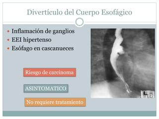 Diverticulos esofagicos | PPTX
