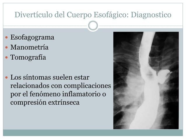 Diverticulos esofagicos | PPTX