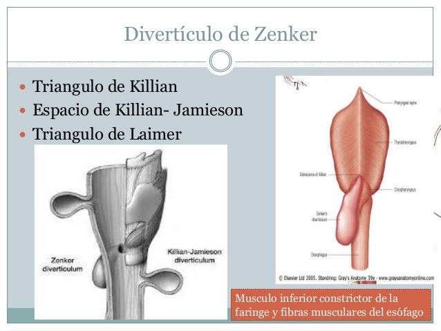 Diverticulos esofagicos