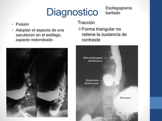 Diverticulos esofagicos | PPT