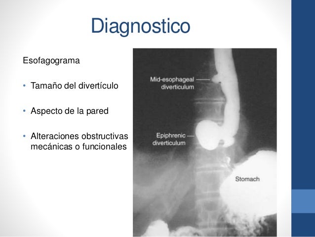 Diverticulos esofagicos