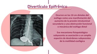 Diverticulos esofagicos | PPTX