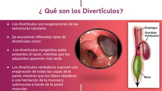 Diverticulos esofagicos | PPT