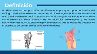 Divertículos esofágicos, síntomas y tratamiento | PDF