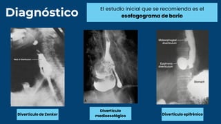 Divertículo Epifrénico
