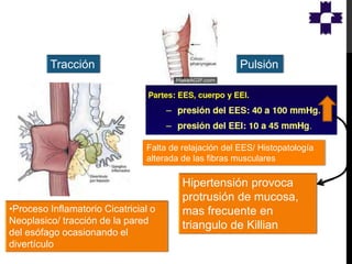 Diverticulos esofagicos | PPTX