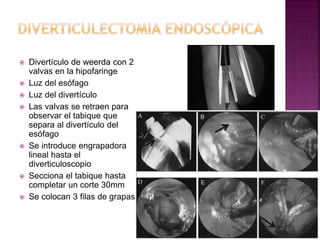 Diverticulos esofagicos expo | PPTX