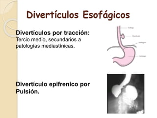 Diverticulos esofagicos | PPTX