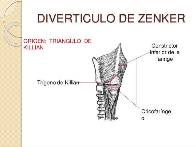 Diverticulos esofagicos
