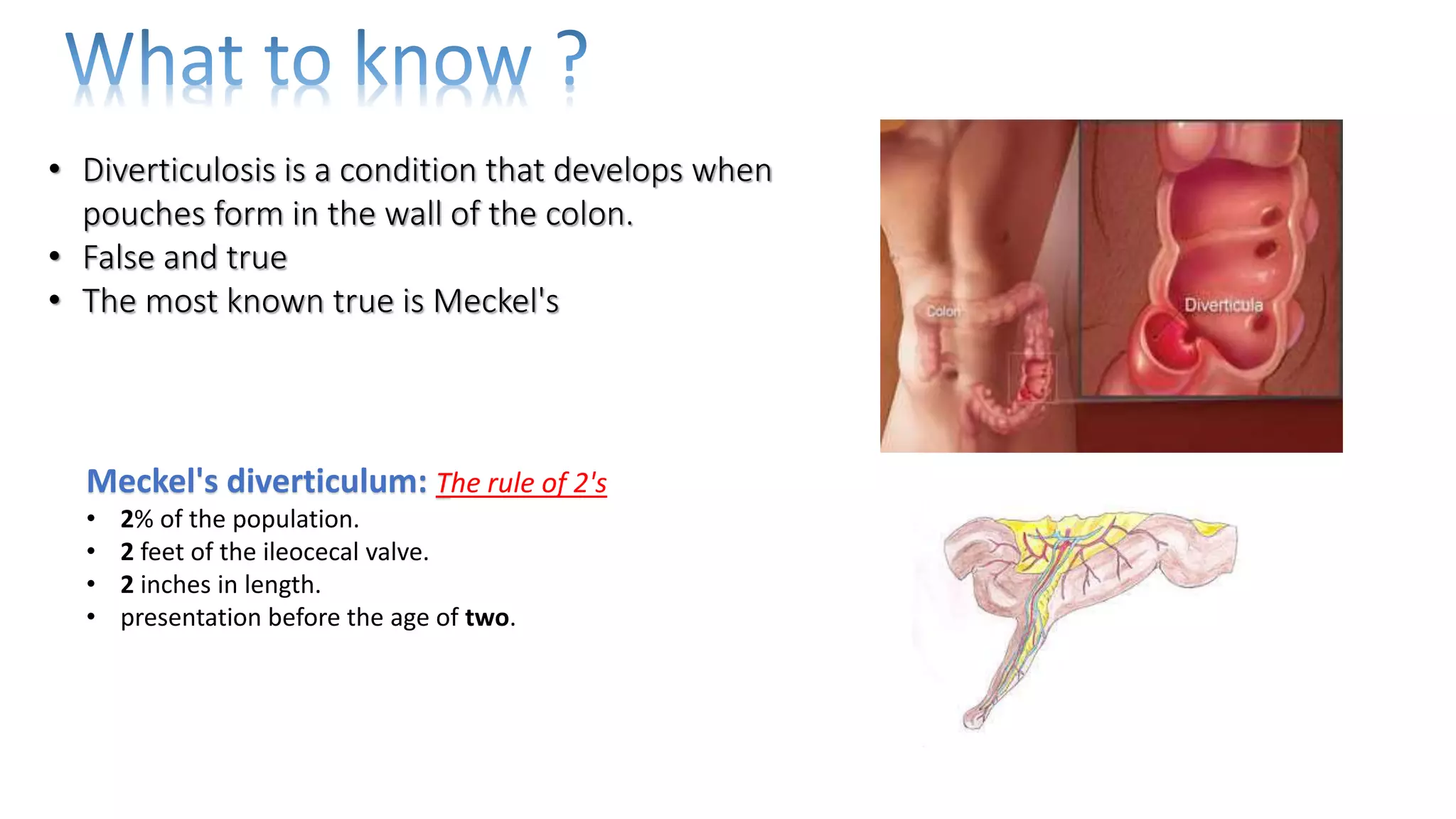 Diverticulosis | PPTX
