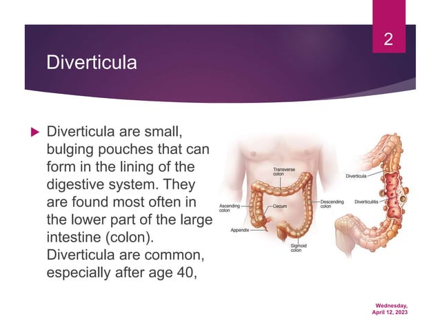 colonic diverticulosis.ppt