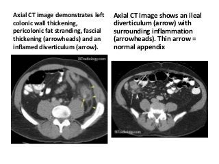 Diverticulosis and diverticular disease | PPTX