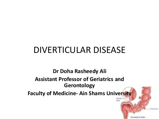 Diverticulosis and diverticular disease | PPT