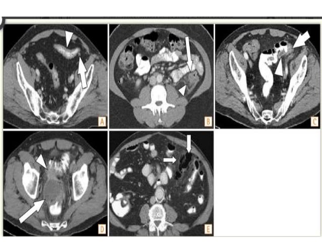 Diverticulosis and diverticular disease | PPT
