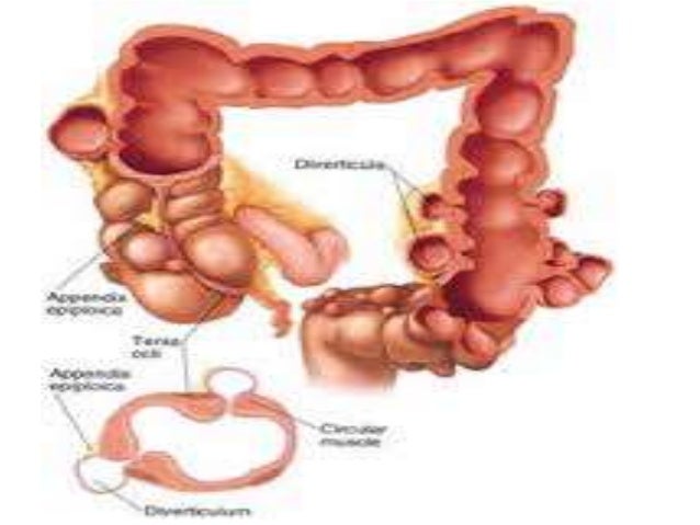 Diverticulosis and diverticular disease | PPT
