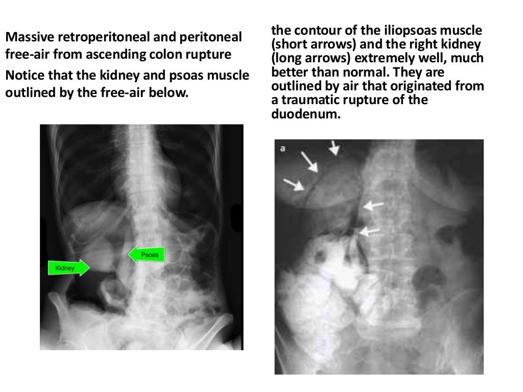 Diverticulosis and diverticular disease | PPT