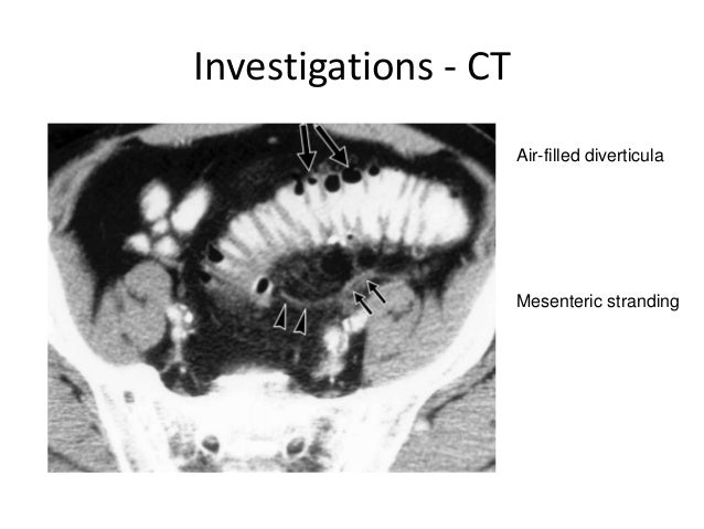 Diverticulosis and diverticular disease | PPT