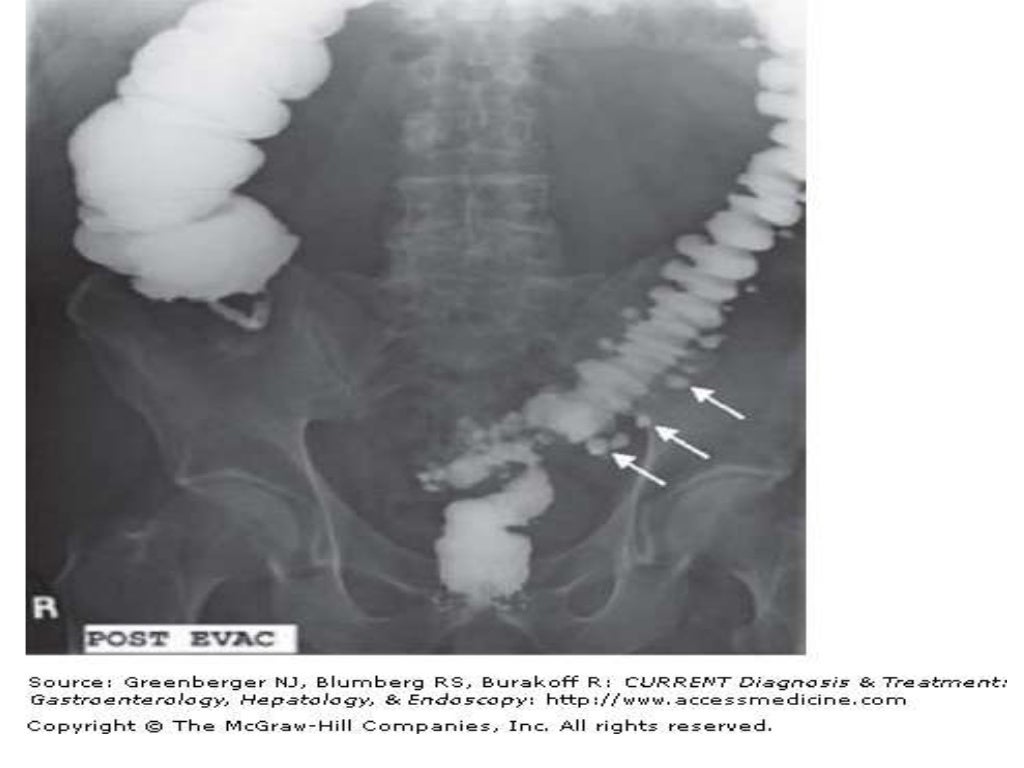 Diverticulosis and diverticular disease | PPT