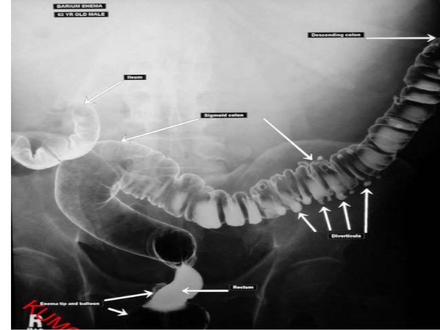 Diverticulosis and diverticular disease | PPT