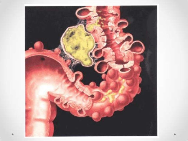 Diverticulosis del colon