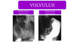Volvulus Birds Beak