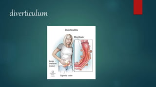 DIVERTICULUM.pptx