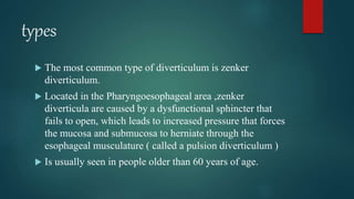 DIVERTICULUM.pptx