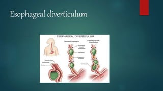 DIVERTICULUM.pptx