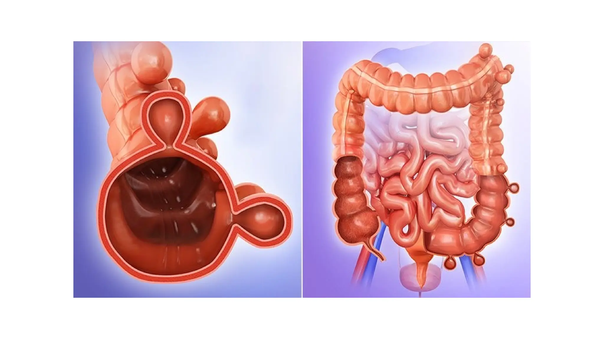 DIVERTICULUM.pptx- introduction, definition, causes,clinical ...