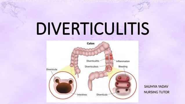 DIVERTICULUM.pptx- introduction, definition, causes,clinical ...