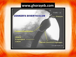 Divertikuli jednjaka | PPSX