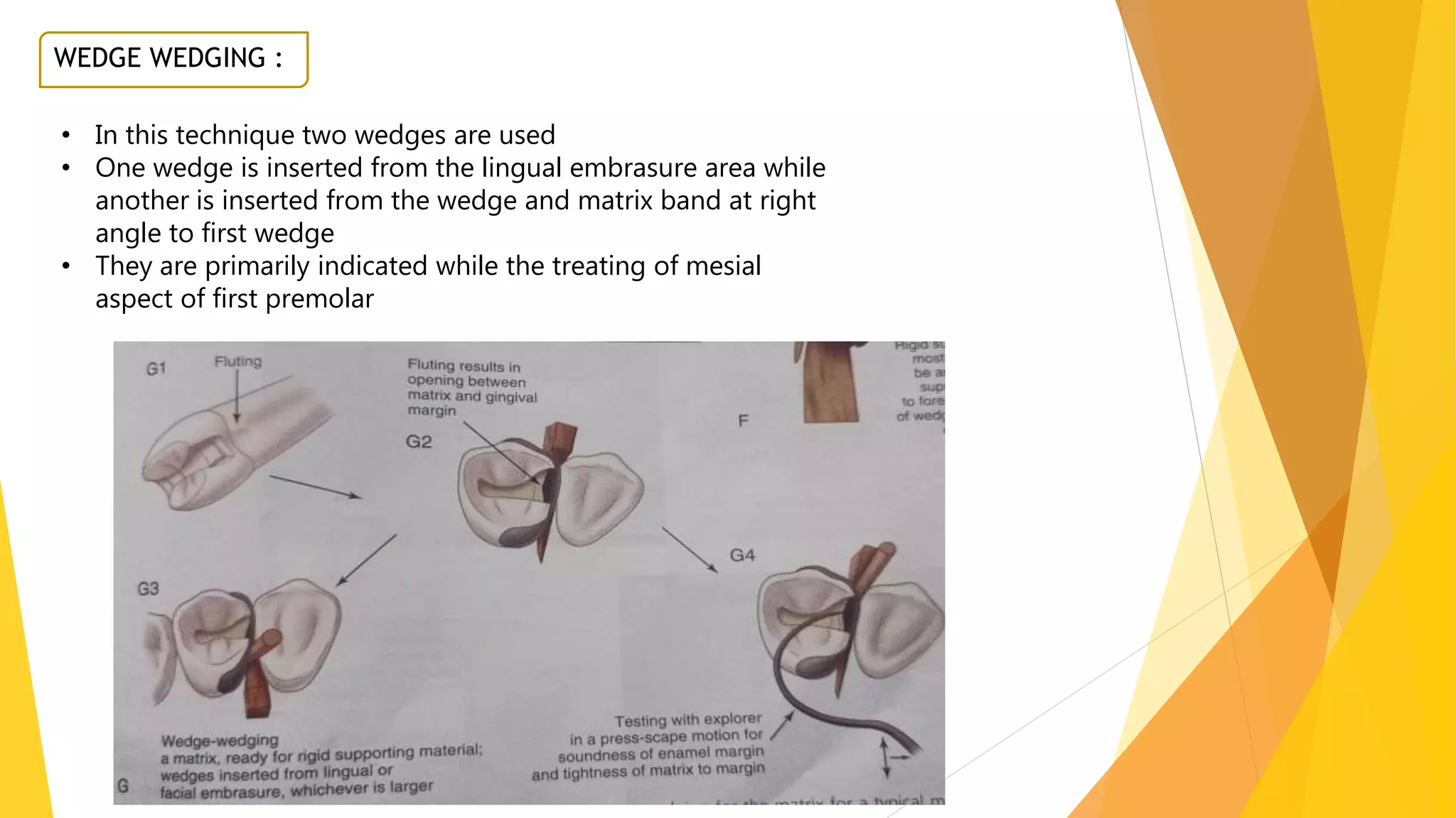 TOOTH PREPARATION FOR CLASS II AMALGAM RESTORATION | PPTX