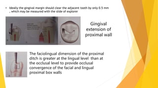 TOOTH PREPARATION FOR CLASS II AMALGAM RESTORATION | PPTX