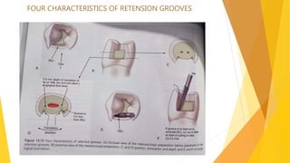 TOOTH PREPARATION FOR CLASS II AMALGAM RESTORATION | PPTX