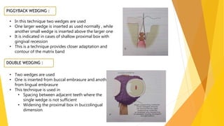 TOOTH PREPARATION FOR CLASS II AMALGAM RESTORATION | PPTX
