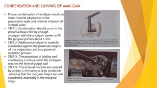 TOOTH PREPARATION FOR CLASS II AMALGAM RESTORATION | PPTX