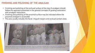 TOOTH PREPARATION FOR CLASS II AMALGAM RESTORATION | PPTX