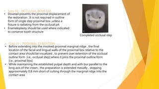 TOOTH PREPARATION FOR CLASS II AMALGAM RESTORATION | PPTX