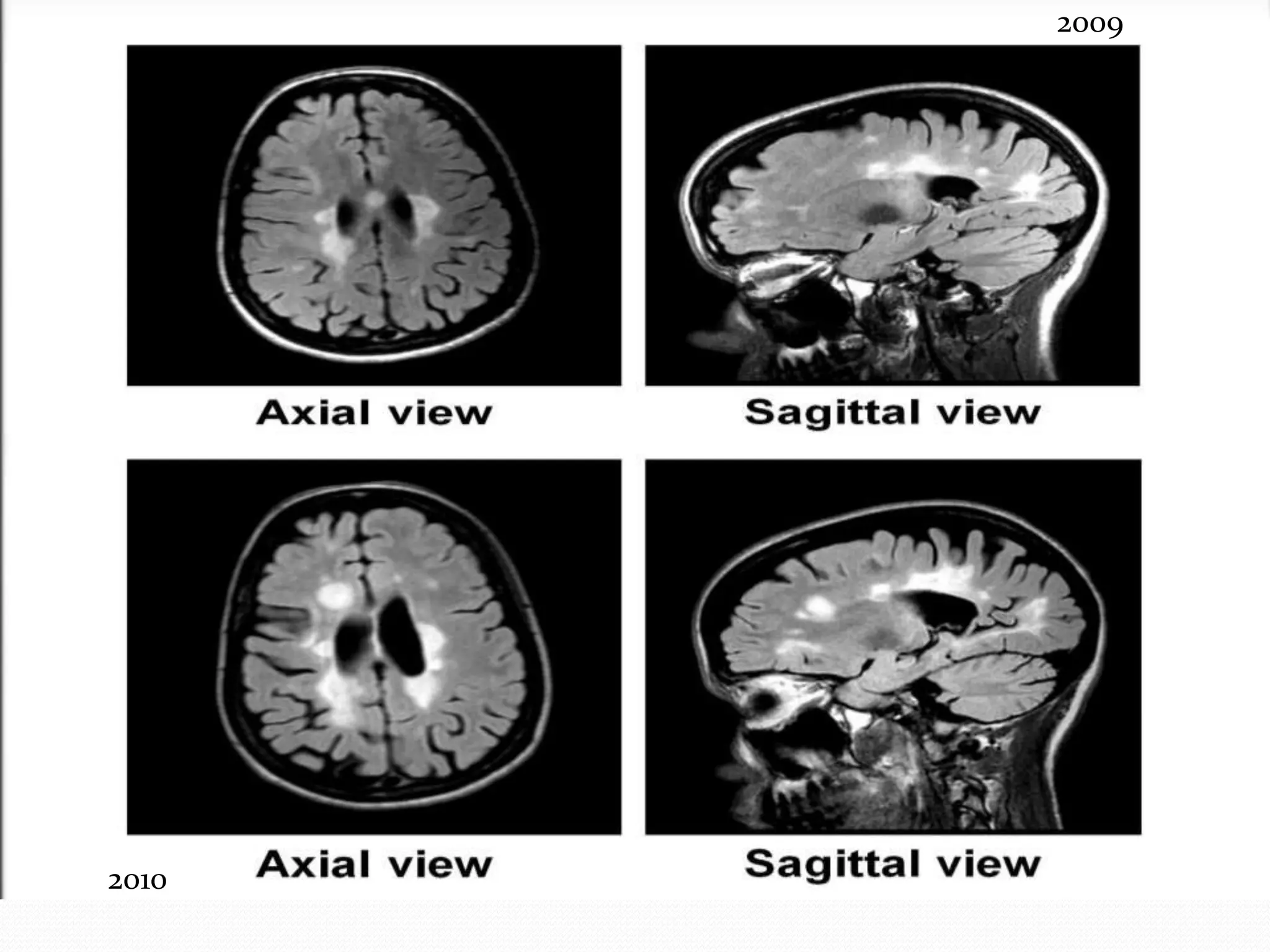 Switching therapy in Multiple sclerosis | PPT