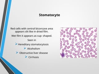 Peripheral blood smear pathology........... | PPTX
