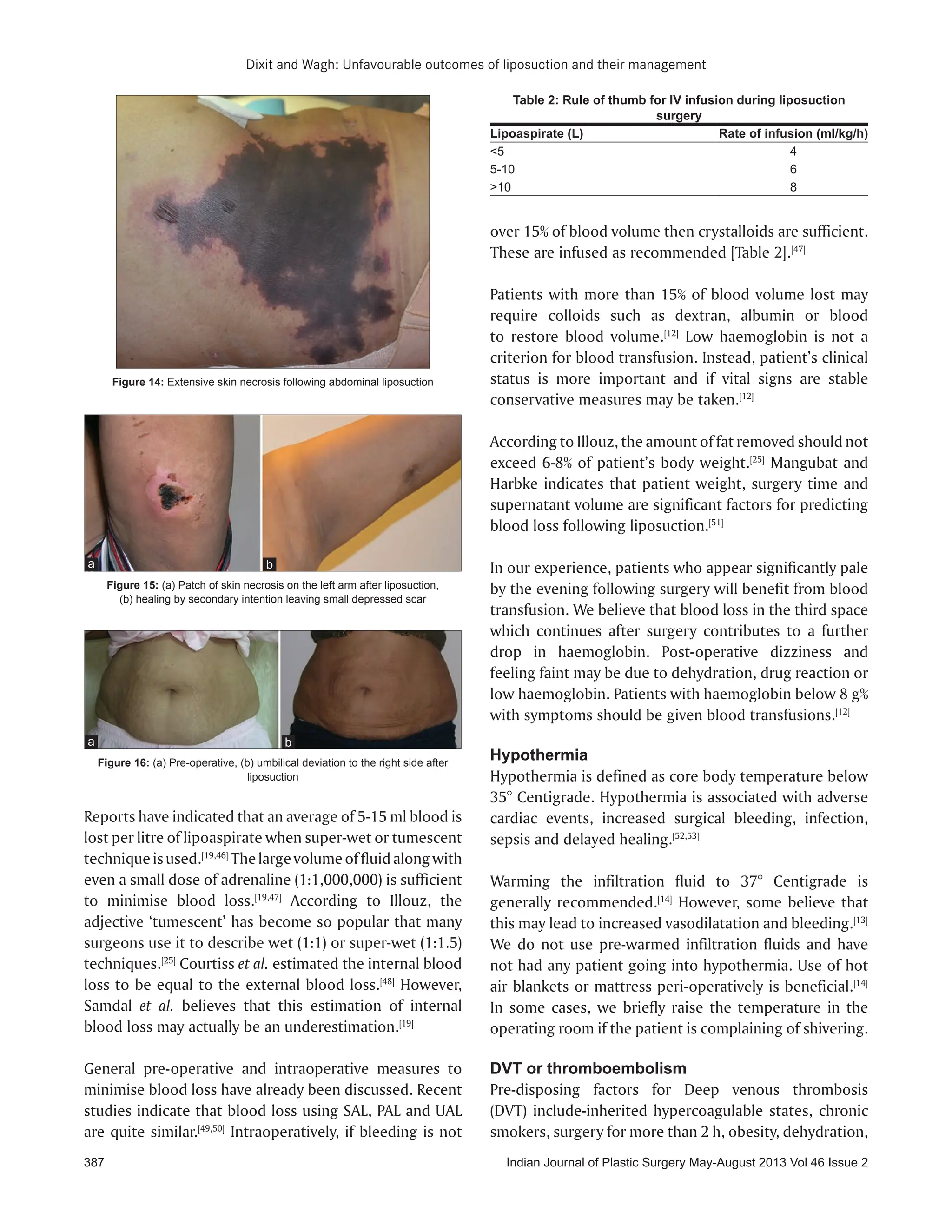 complications of liposuction powerpoint presentation | PDF