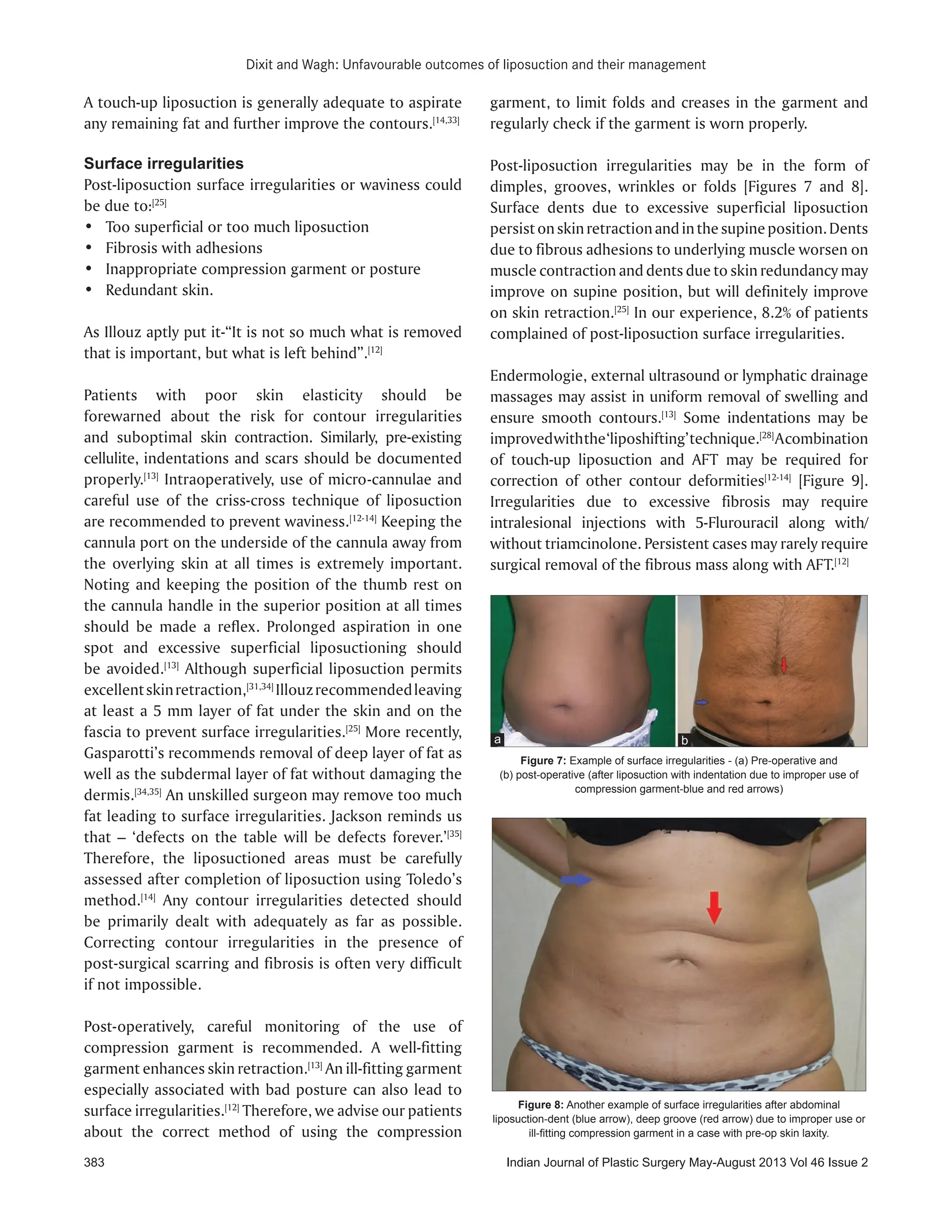 complications of liposuction powerpoint presentation | PDF