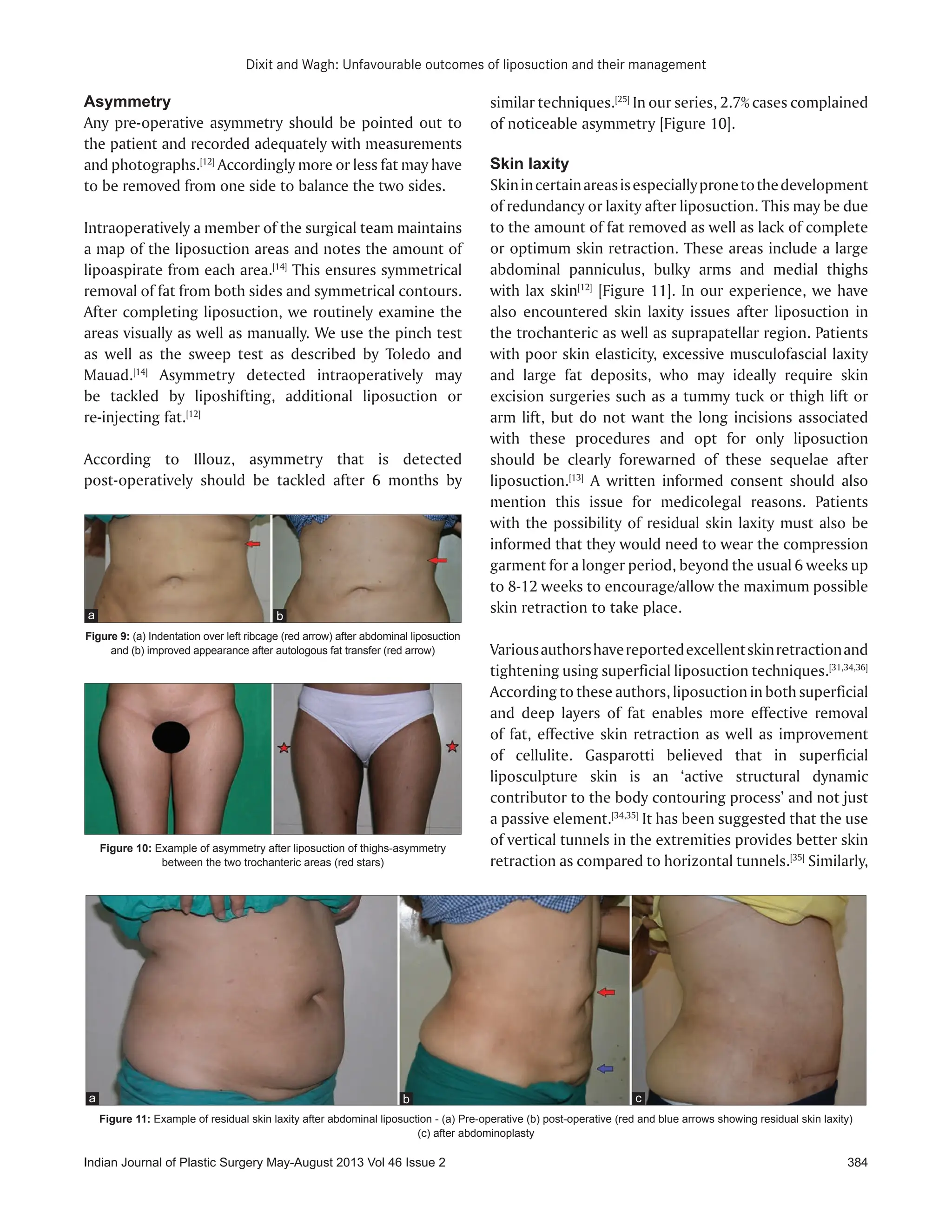 complications of liposuction powerpoint presentation | PDF