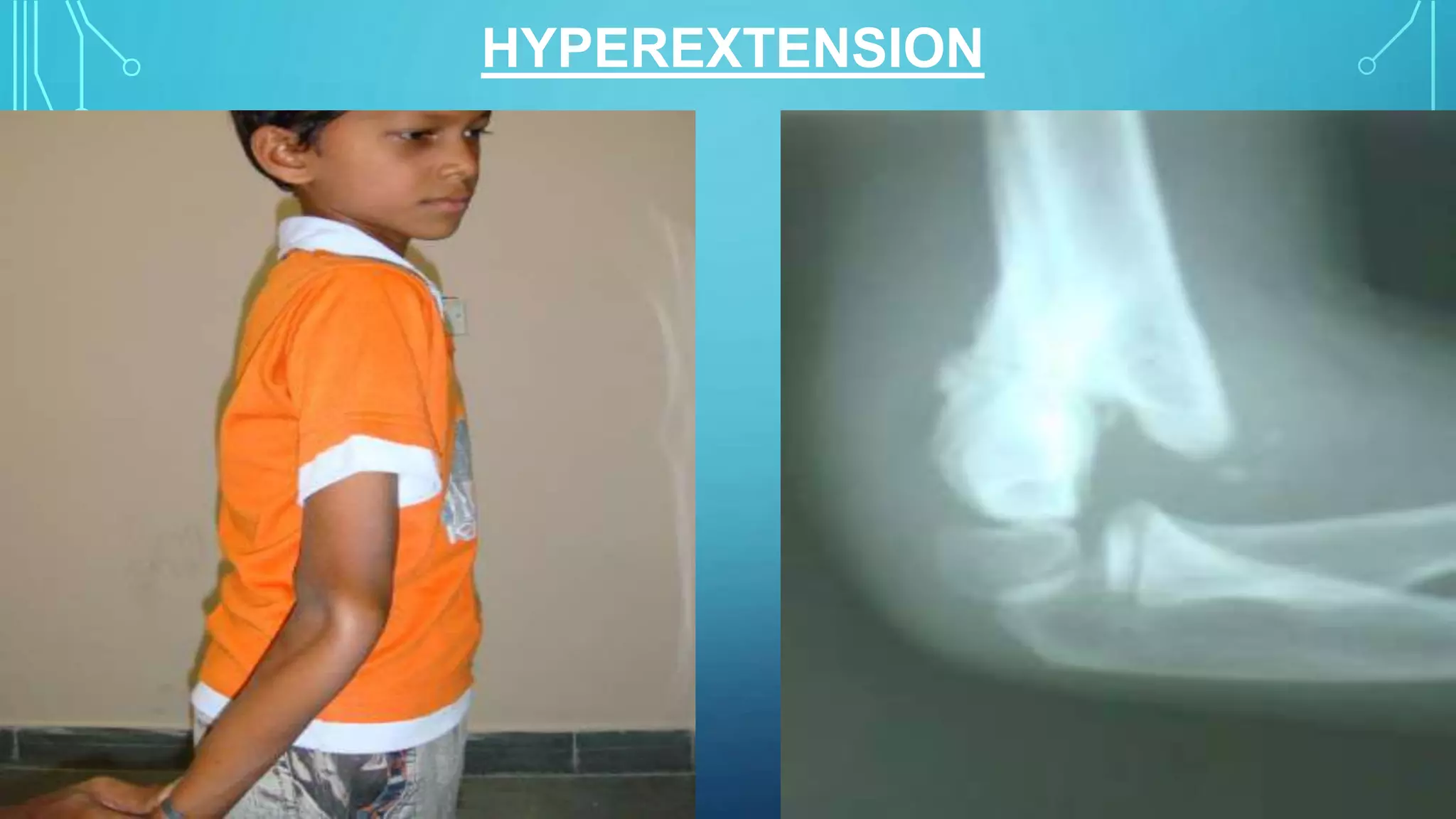 Elbow examination and its clinical applied | PPT