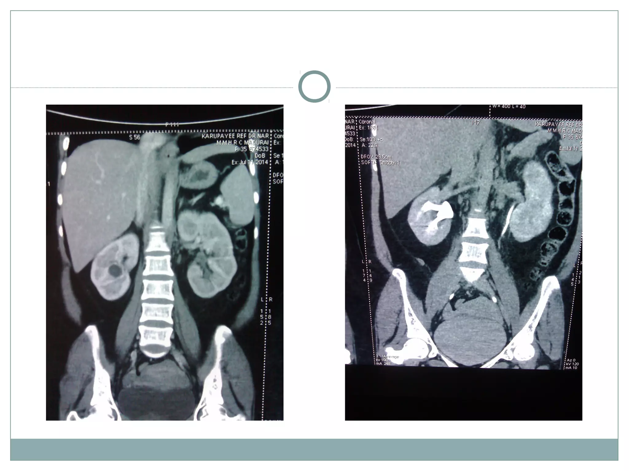 DJ Stenting or Percutaneous nephrostomy(PCN) in acute pyelonephritis | PPT