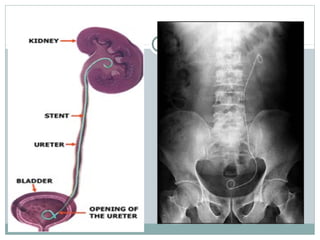 Bilateral Nephrostomy