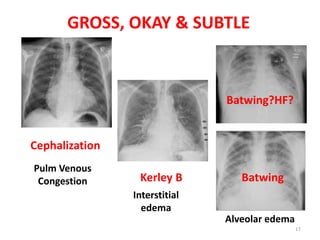HEART FAILURE MANAGEMENT | PPTX